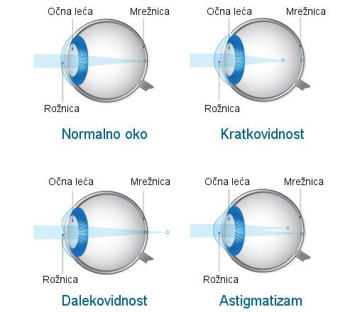 Laserska korekcija vida i astigmatizam | Optometrija.net