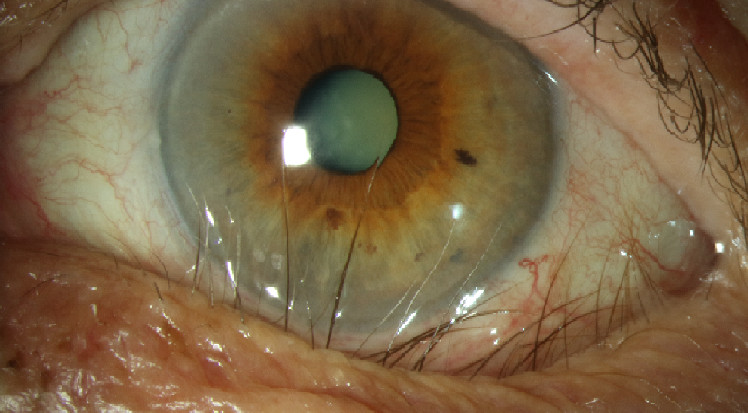 Entropij ili uvrnuti kapak – Simptomi, Uzroci i Liječenje | Optometrija.net