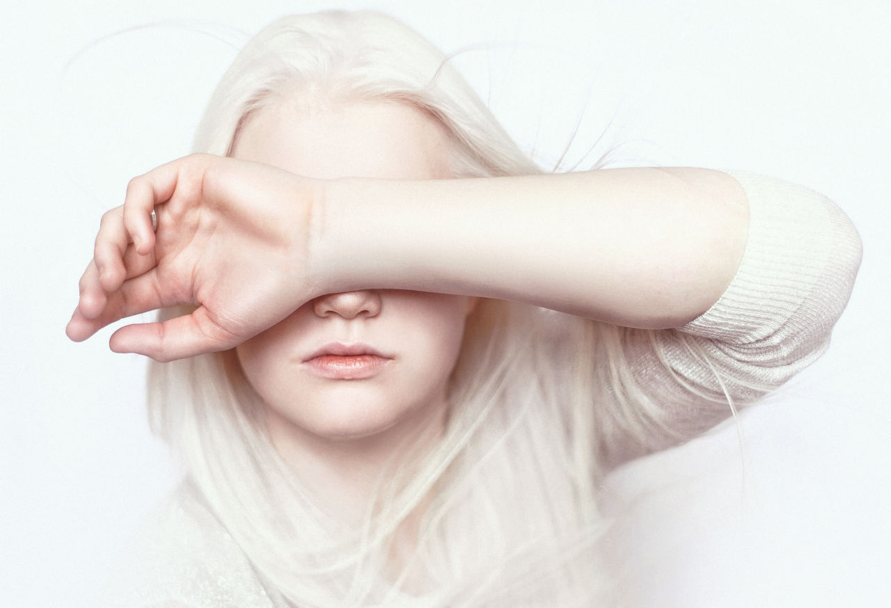 Utjecaj albinizma na oči - Vrste, Uzroci i Simptomi | Optometrija.net