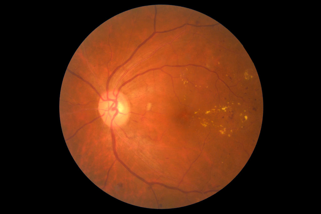 Dijabetička retinopatija - Uzroci, Simptomi i Liječenje | Optometrija.net