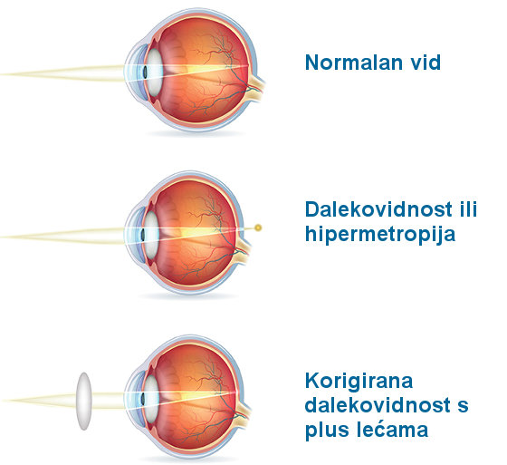 Dioptrija Plus ili Dalekovidnost - Što to znači? | Optometrija.net