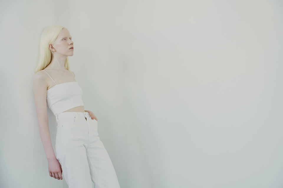 Očni albinizam – uzroci, simptomi i liječenje | Optometrija.net