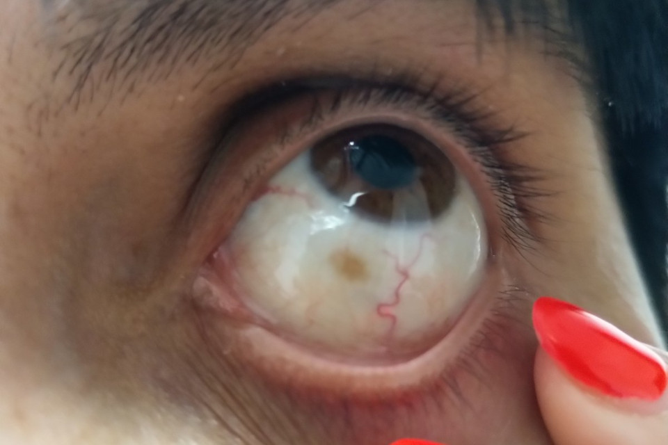 Smeđa mrlja na bjeloočnici - ima li razloga za zabrinutost ...